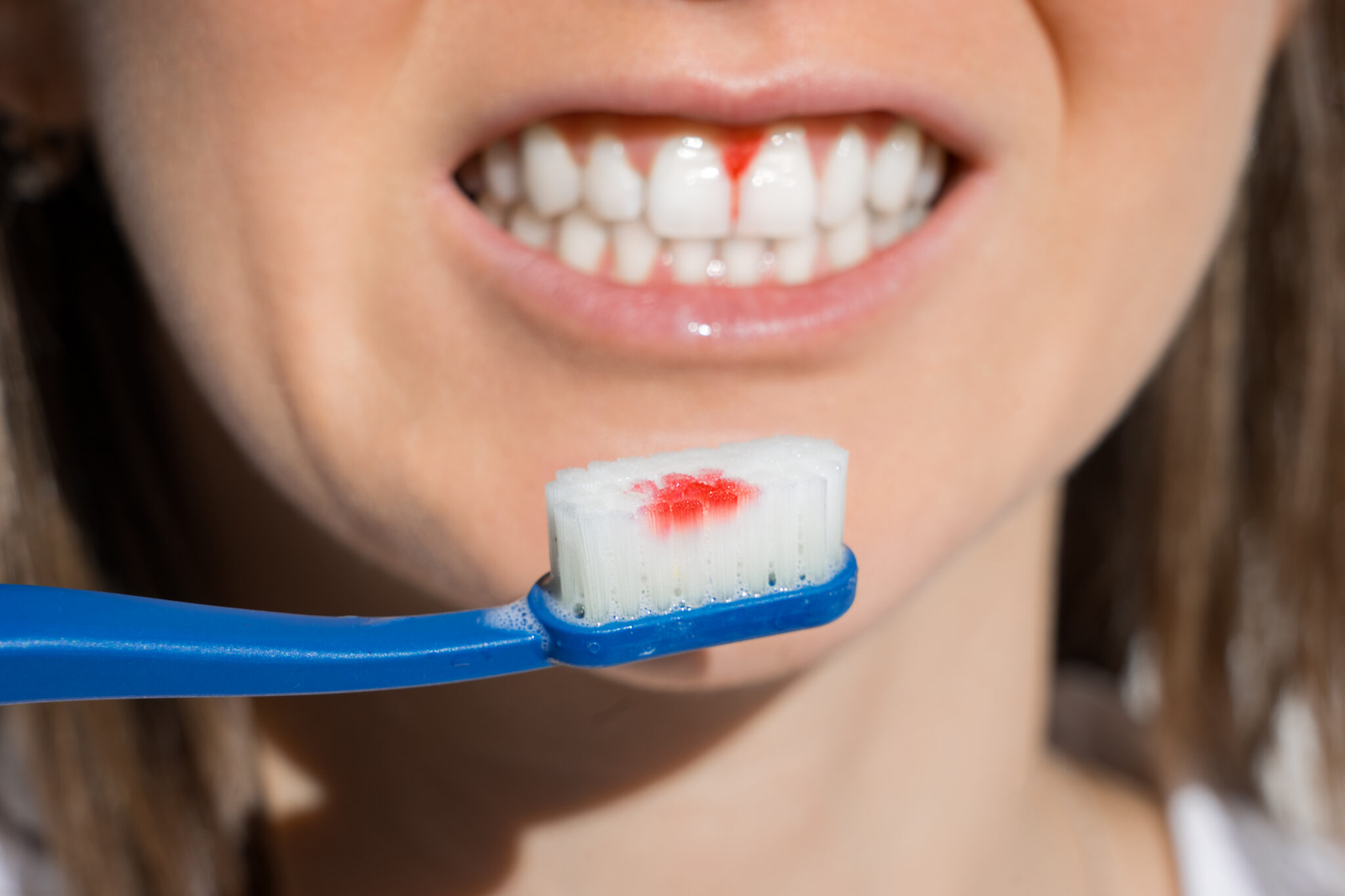 Periodontal Pockets: Can They Be Reversed?